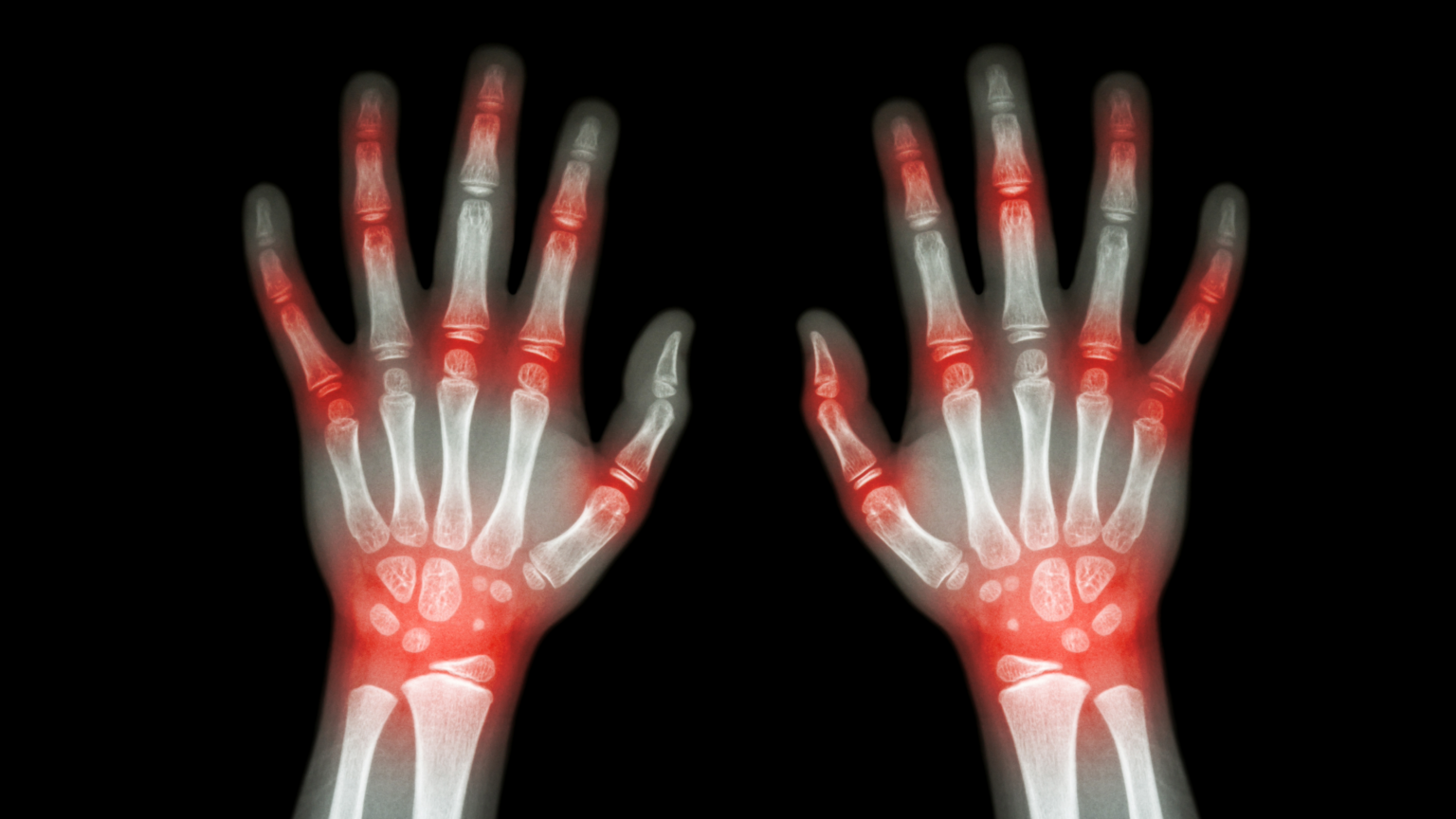 How Hand Therapy Can Help Manage Arthritis-Related Hand Pain | Hands ...