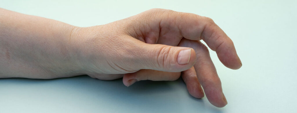 Recovering After Dupuytren’s Contracture Surgery: How Hand Therapy Can ...